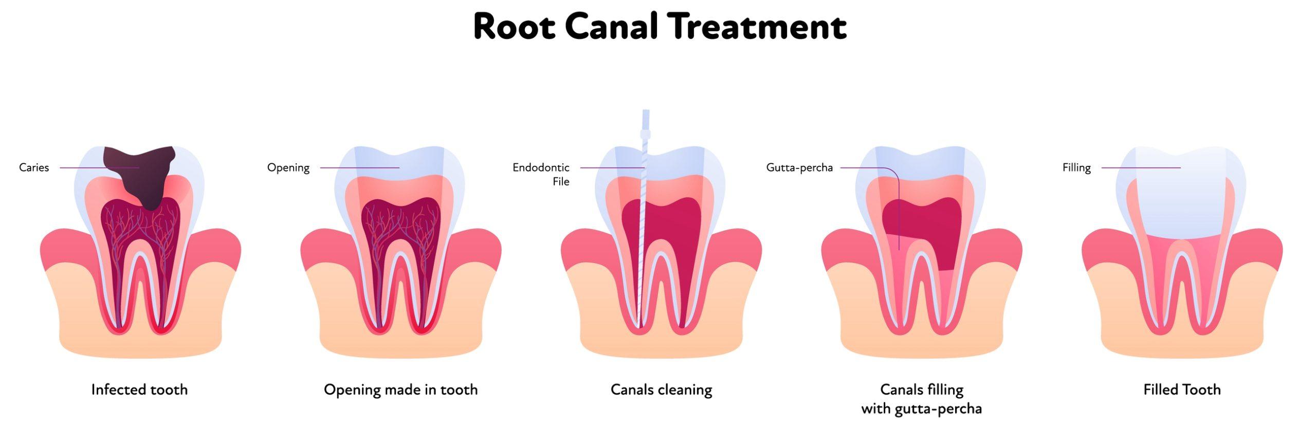 Endodontics | Clarence Street Dental